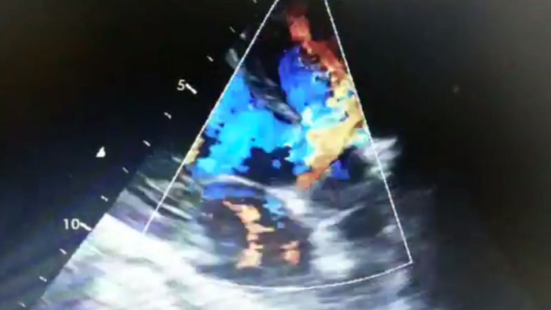 Lečenje defekta septuma - MedicSpark.rs
